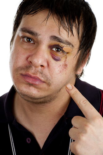 What is a Black Eye? :: Eye Health Central